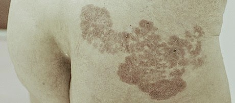 Prostate Cancer Survivor: Eczema misdiagnosis turns out to be cancer