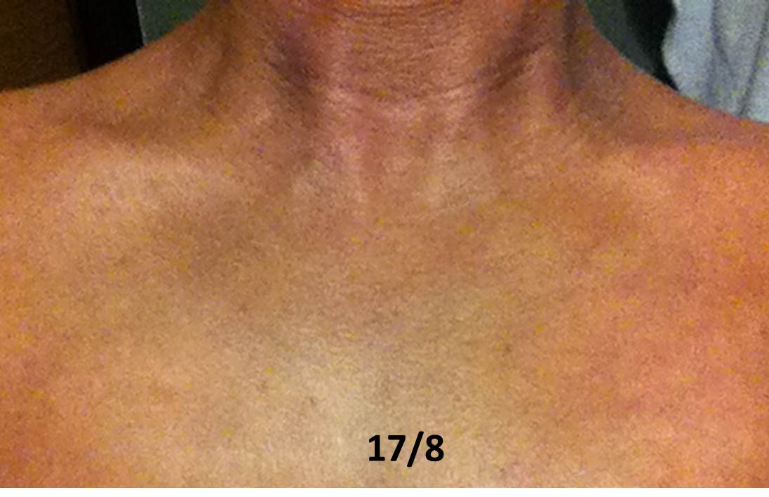 Marks of Life: Progression from the big flare (neck)