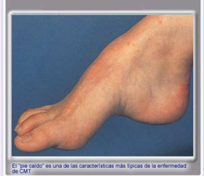 Diseño de Ortesis para pie caído: PLANTEAMIENTO DEL PROBLEMA