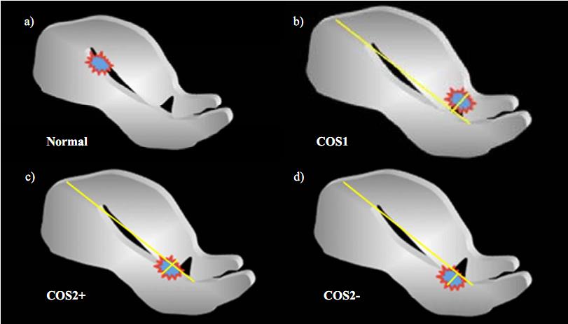 Bác Sĩ Võ Tá Sơn: CROSS-OVER SIGN (COS) – DẤU HIỆU MỚI TRÊN SIÊU ÂM ĐỂ ...