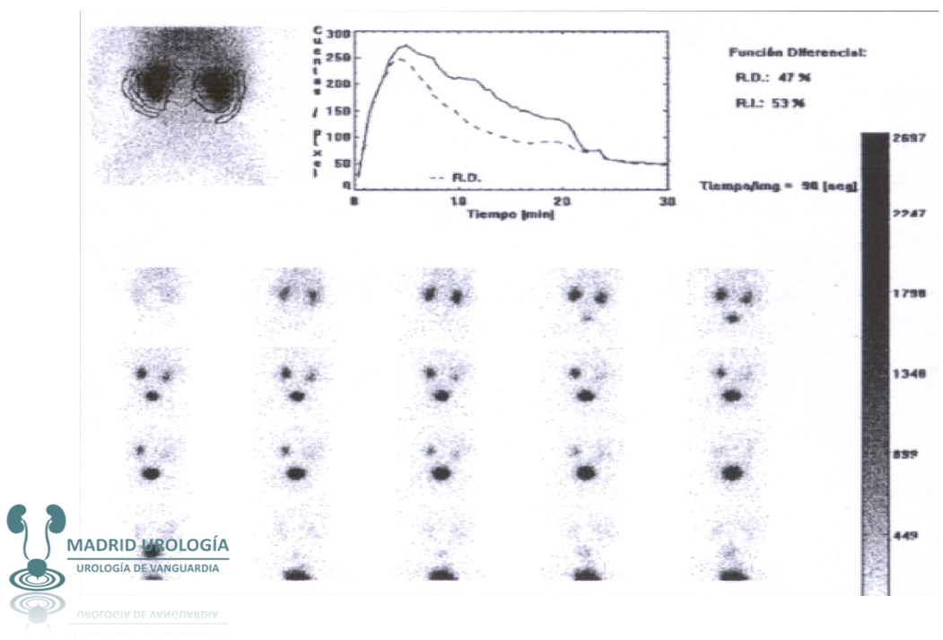 Urología Peruana: Dr. Susaníbar: El radiorenograma