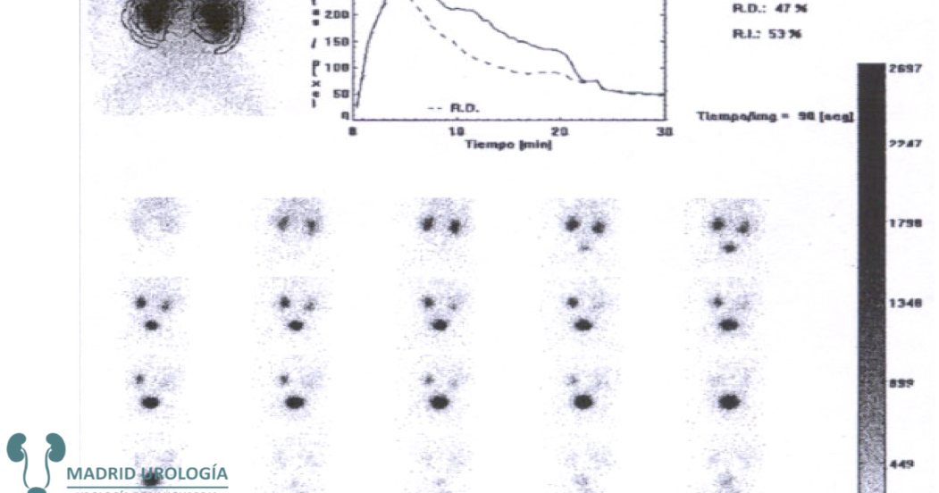 Madrid Urología: RENOGRAMA MAG 3. Medicina Nuclear. Capítulo 2.