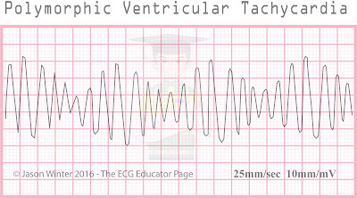ECG Educator Blog : Ventricular Rhythms