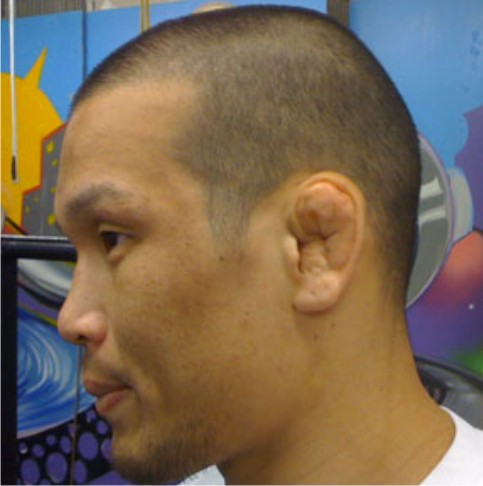 ICHIBAN. El judo y las lesiones.: Oreja del luchador