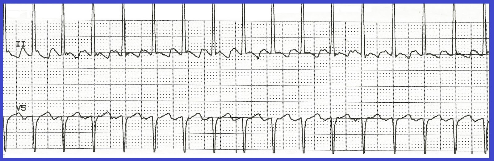 Float Nurse: Practice EKG Rhythm Strips 185