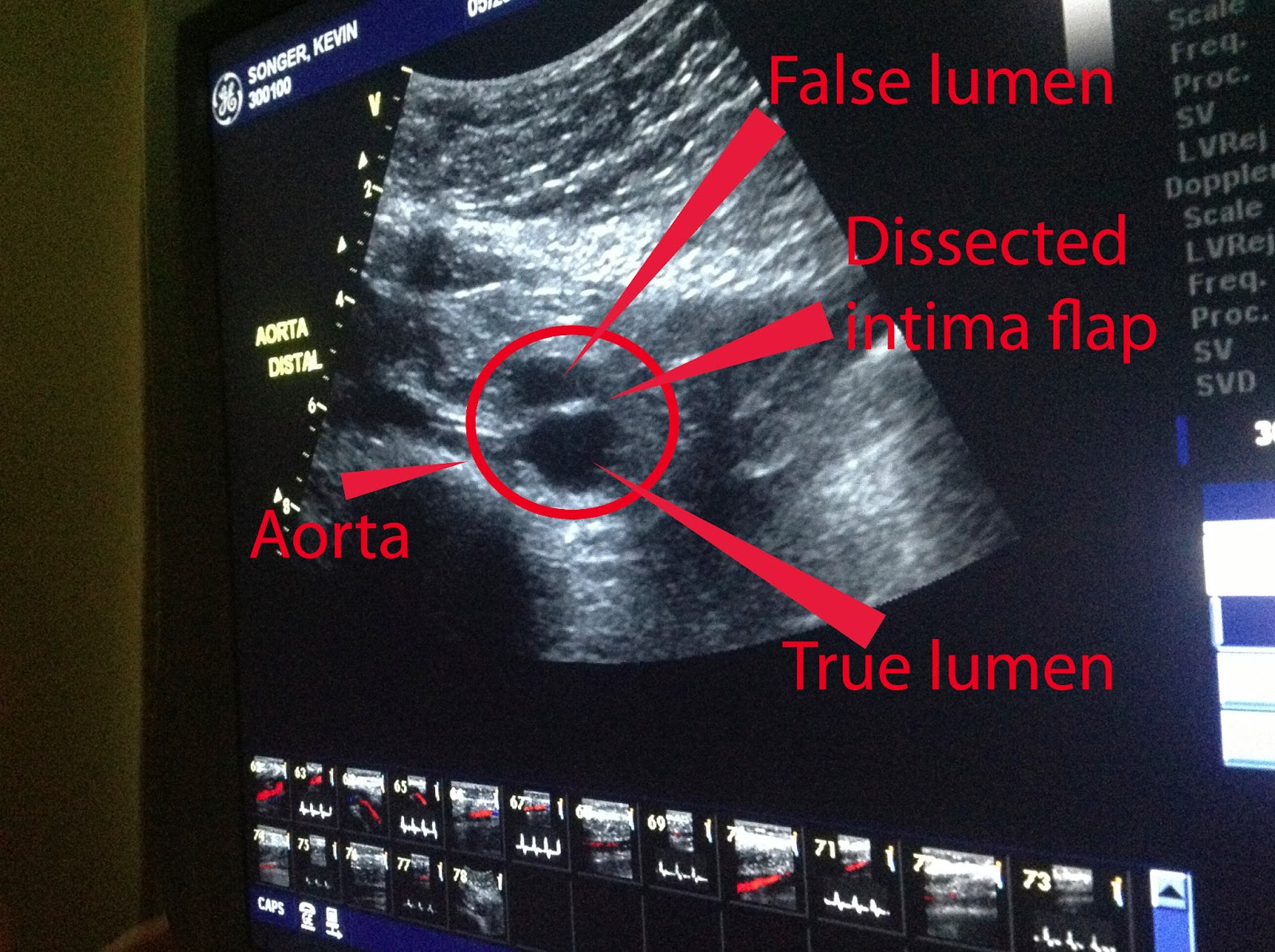 Aortic Dissection Ultrasound