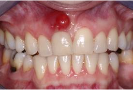 Penyakit Gigi dan Mulut: Abses Periapikal