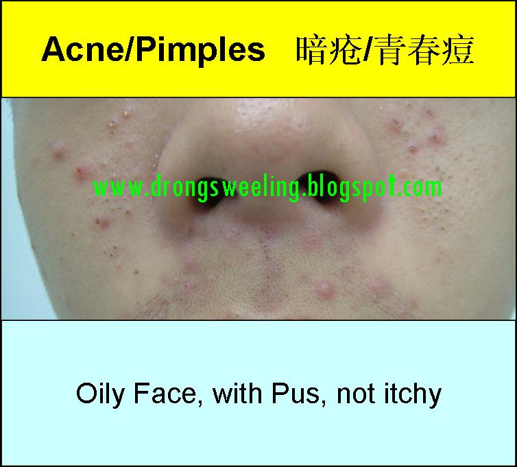 TCM News: TCM Physician Treatment for Acne in Singapore