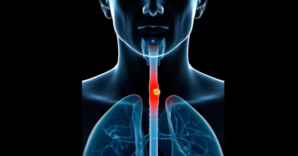 TERAPIAS ALTERNATIVAS: Dieta para la úlcera Esofágica