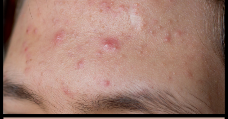 10 Super-Effective Remedies To Get Rid Of Zits Quickly - Lizy Style