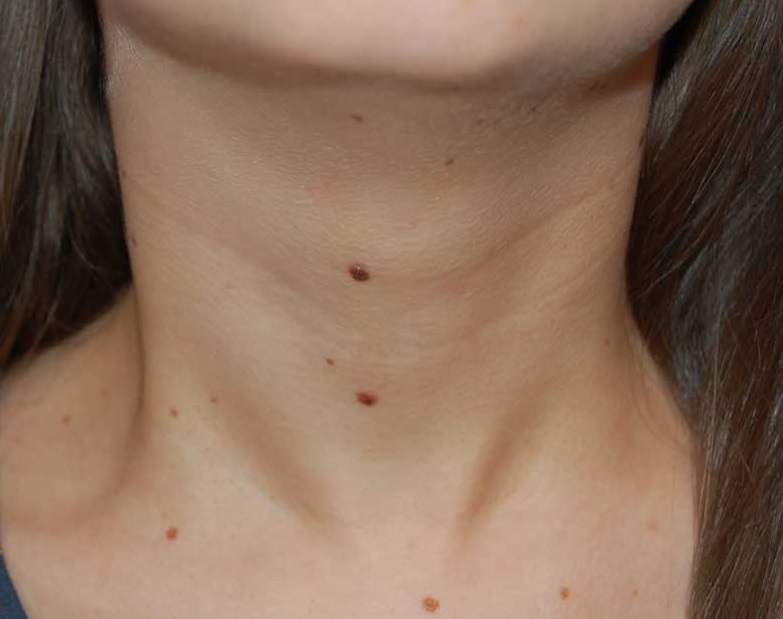 Photos of Moles on Face and Neck ~ How To Remove Moles, Warts, Skin ...