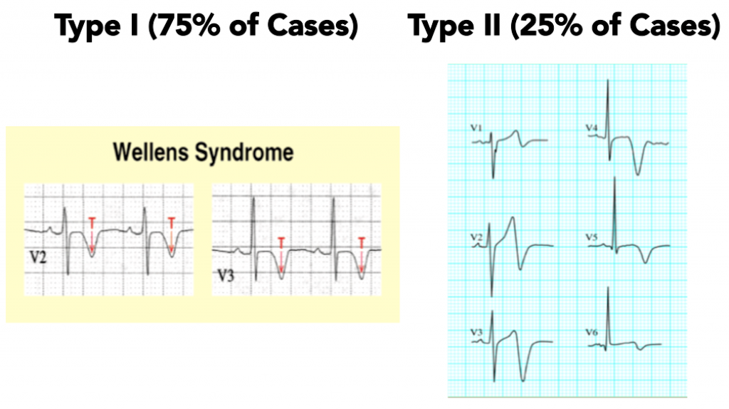 Síndrome de Wellens | Enciclopédia de ECG - ECG de A a Z