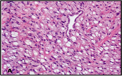 GO BIG or GO HOME: Pathology of prostate gland adenocarcinoma and its ...