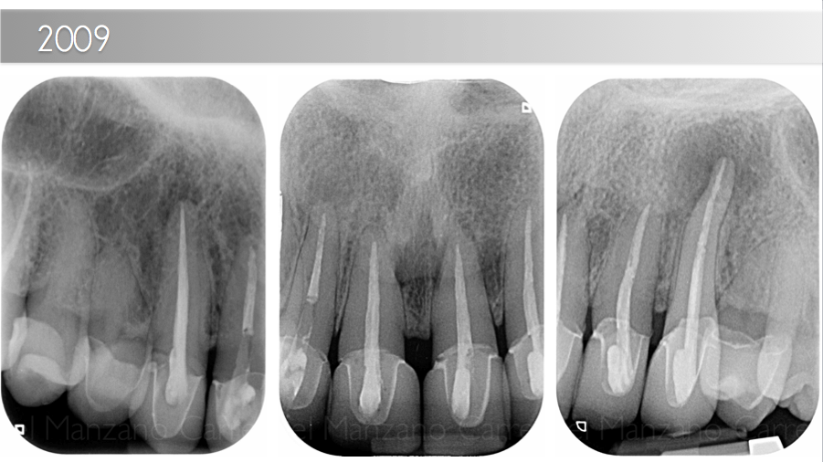Caso clínico. Retratamientos y cirugía...