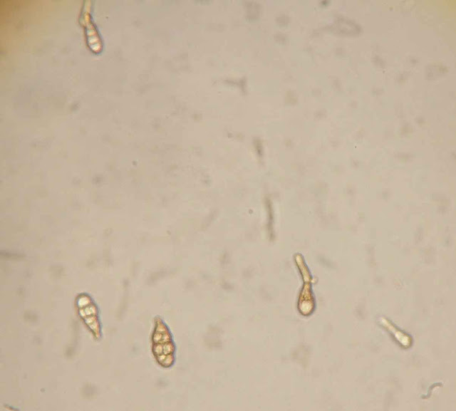 ATLAS MICOLOGIA: HYPOPYON (HIPOPION) POR ALTERNARIA