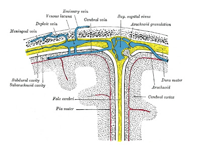 Chronic Subdural Hematomas - MRI - Radiology Imaging