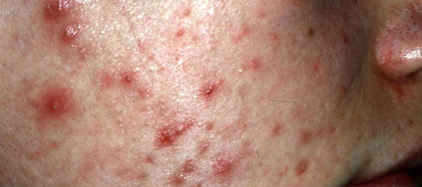 Acne Vulgaris ~ RD's Blog