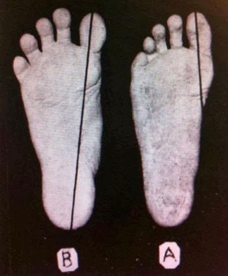 Guest Post: The Effects of Toe Orthosis on Dynamic Balance by Adam ...