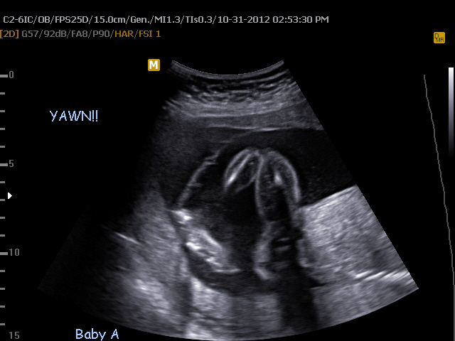 A Road Well Traveled: Anatomy Scan- 21 weeks!