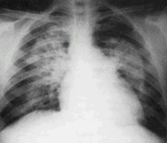 Asuhan keperawatan Edema Paru ( Acute Lung Oedema ) KMB - AINUR MALINDA