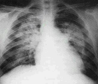 Asuhan keperawatan Edema Paru ( Acute Lung Oedema ) KMB - AINUR MALINDA