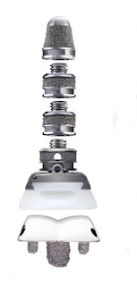 The Daily Fix: Wright Medical Announces Launch of Inbone II Ankle Implant