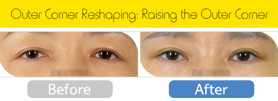 Eyelid Surgery Legend Dr. Kim Byung Gun: [BK Plastic Surgery Hospital ...