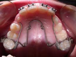 DISEÑAR APARATOLOGIA: QUAD HELIX