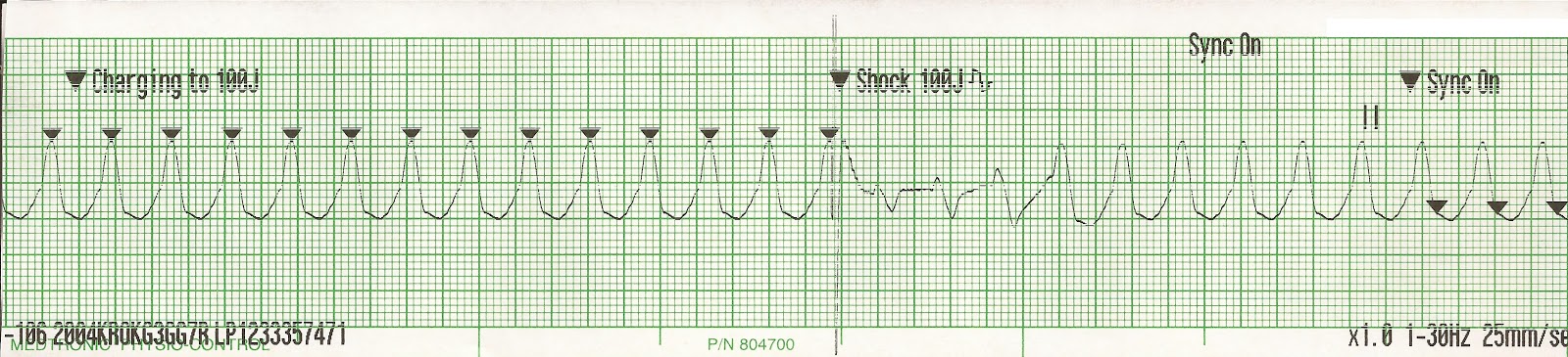 ECG Rhythm Strip Quiz 85: Electrical interventions