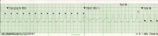 ECG Rhythm Strip Quiz 85: Electrical interventions