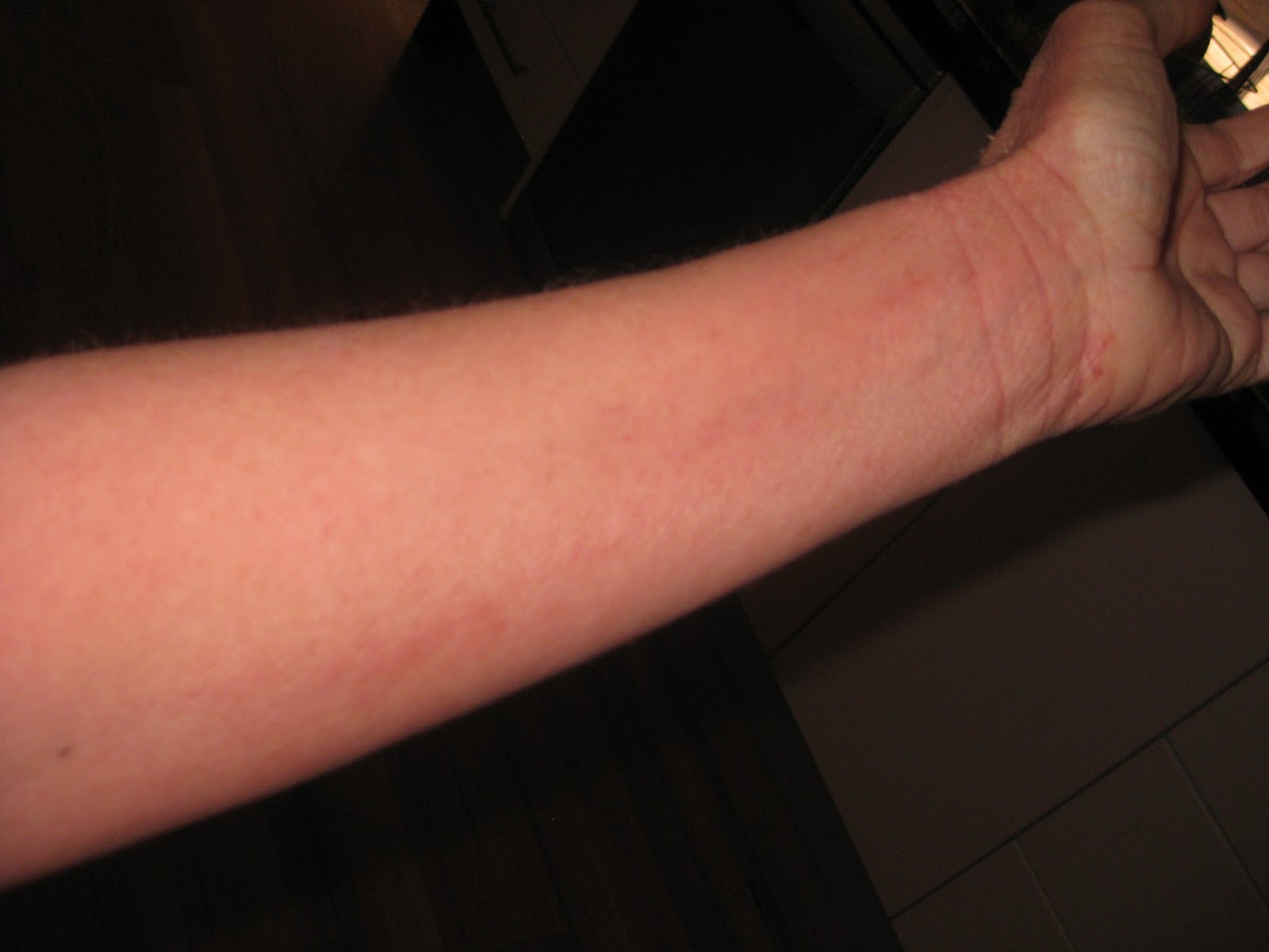 Topical Steroid Withdrawal Journey-Healing Eczema and Red Skin Syndrome ...