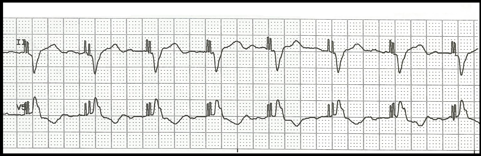 ECG Rhythm Strip Quiz 107