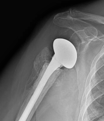 UW Shoulder and Elbow Academy: Conversion of a failed hemiarthroplasty ...