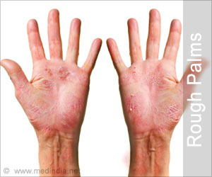 Babesiosis / Babesia : Rough Palms