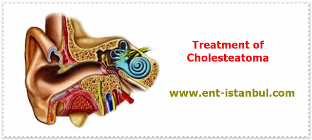 Cholesteatoma - Definition, Symptoms, Complications and Treatment