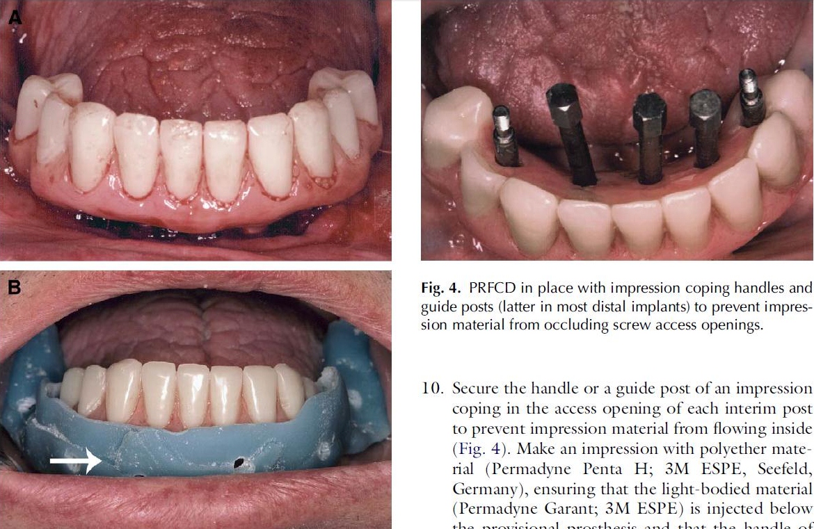 Implant supported prosthesis steps for the dentist - Bauer Smiles