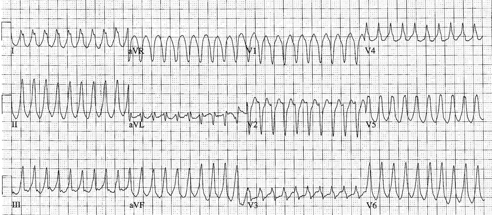 ECG of the Week: ECG of the Week - 7th May 2012 - Interpretation
