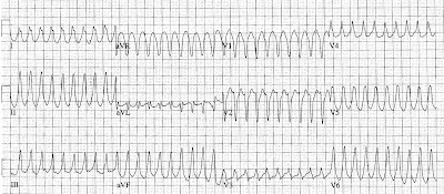 ECG of the Week: ECG of the Week - 7th May 2012 - Interpretation