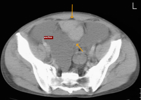 Bladder Rupture-CT - Sumer's Radiology Blog