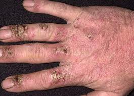 SALUD: Tratamiento Dishidrosis: ¿Cómo usted puede ayudar