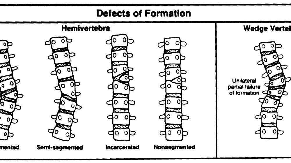 Congenital vertebral anomaly