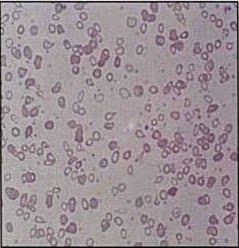 Células importantes en hematología: HIPOCROMIA