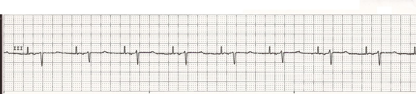 ECG Rhythm Strips 74