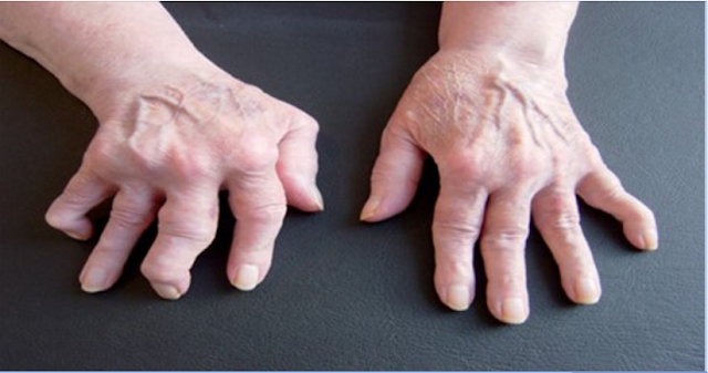 OVA ŽENA JE IZLIJEČILA REUMATIZAM SAMA! SAZNAJTE KAKO!(RECEPT) « Kolaci ...