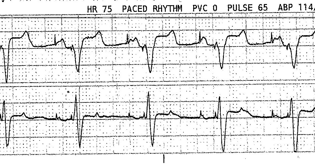 ECG Rhythms: Interesting Pacemaker Behavior