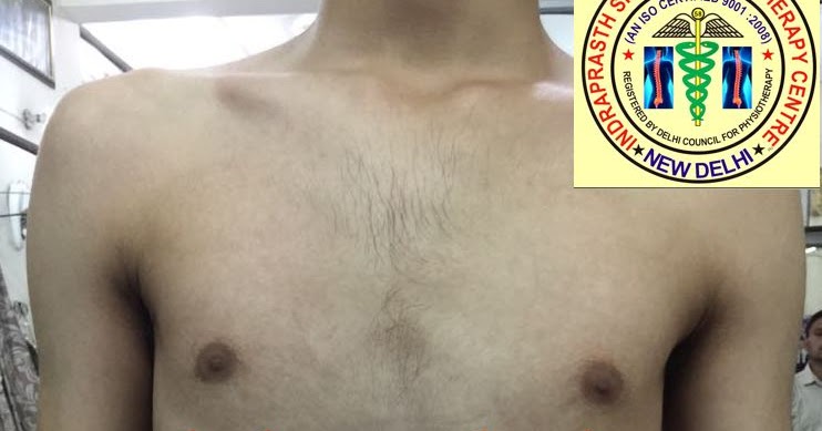 INDRAPRASTH PHYSIOTHERAPY CENTRE: PIGEON CHEST (PECTUS CARINATUM)