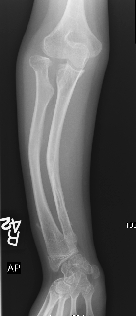 Multiple Hereditary Exostosis- Its Not Always about the X-rays ...