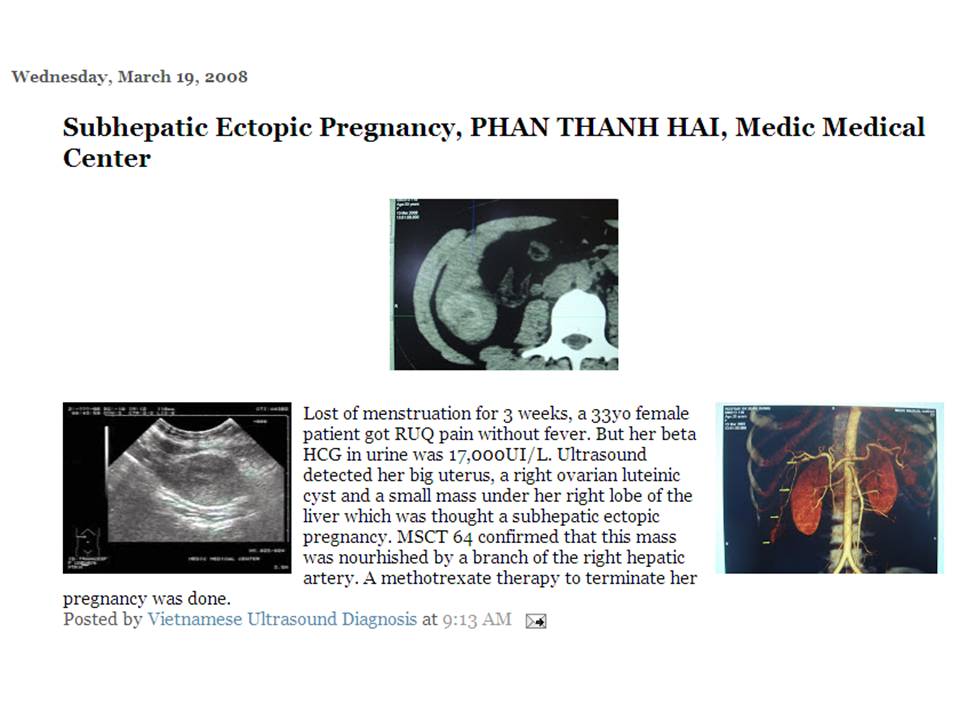 VIETNAMESE MEDIC ULTRASOUND: CASE 172: HEPATIC ECTOPIC PREGNANCY, Dr ...