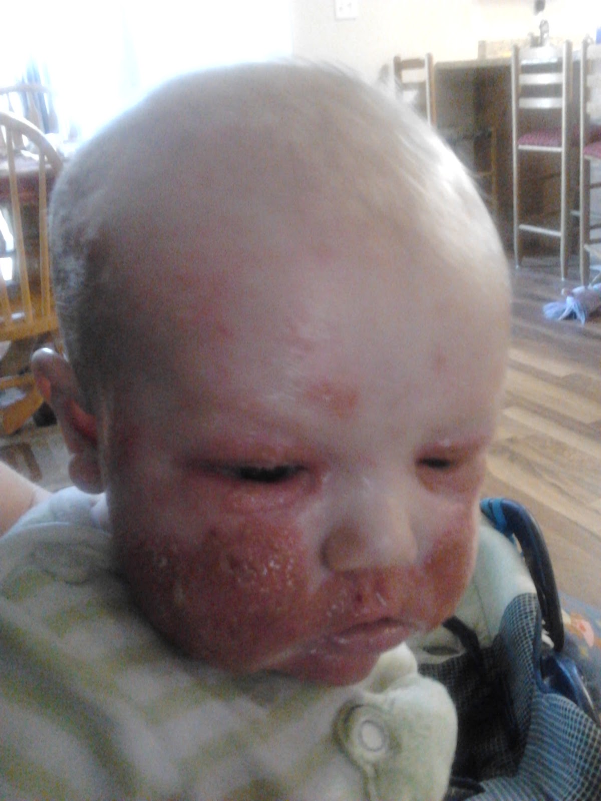 Adams Family: Severe Allergy Induced Eczema On My Infant.