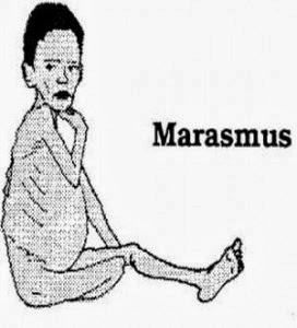 8 Common Cause of Marasmus « NANDA - Nursing Diagnosis